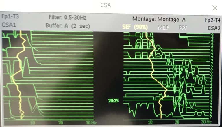 Setting up the Compressed Spectral Array (CSA) | Paediatric Emergencies